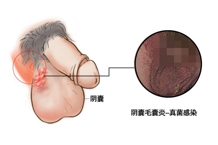 男性真菌感染症状图片图标