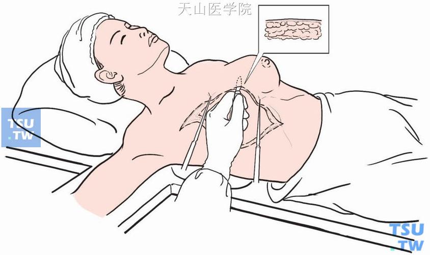 乳腺癌手术动画视频演示截图