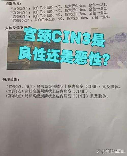 宫颈cin3是良性还是恶性图标