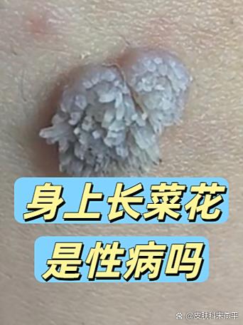 特别小的像针尖一样的疣体图标