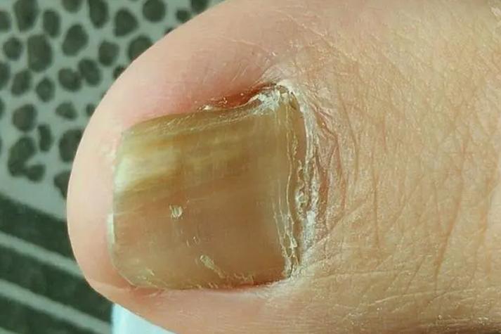左脚大拇指中间有一道竖纹截图
