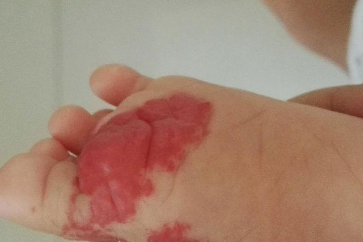 脚上红色块状图片