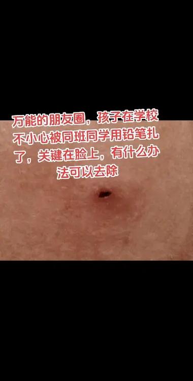 铅笔扎了怎么去除黑色印