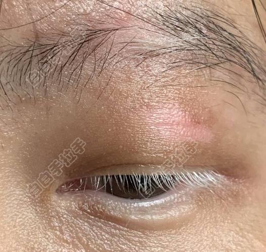 眼皮上有白色斑块图标