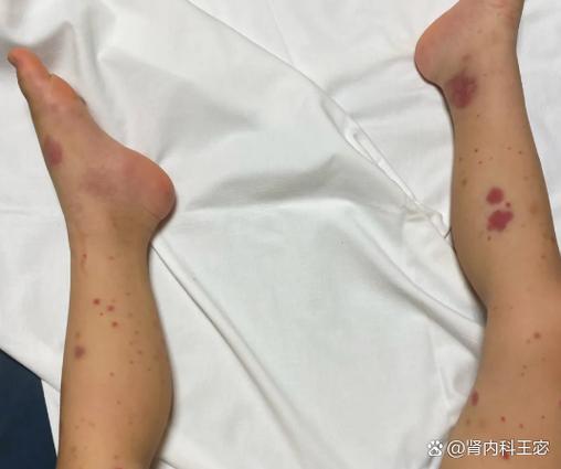 哪种紫癜不需要治疗