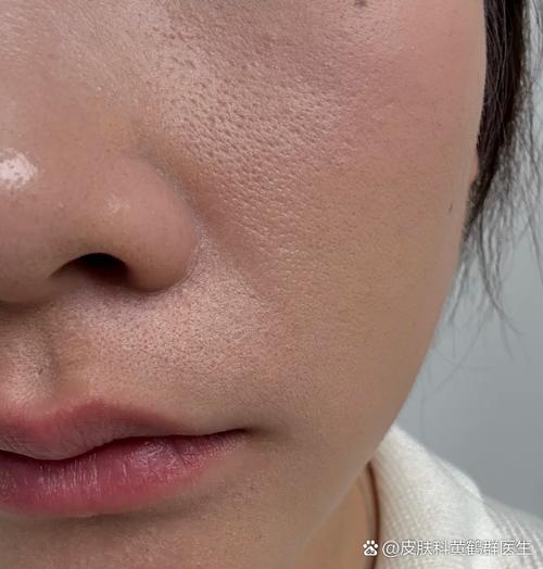 脸部黑头截图