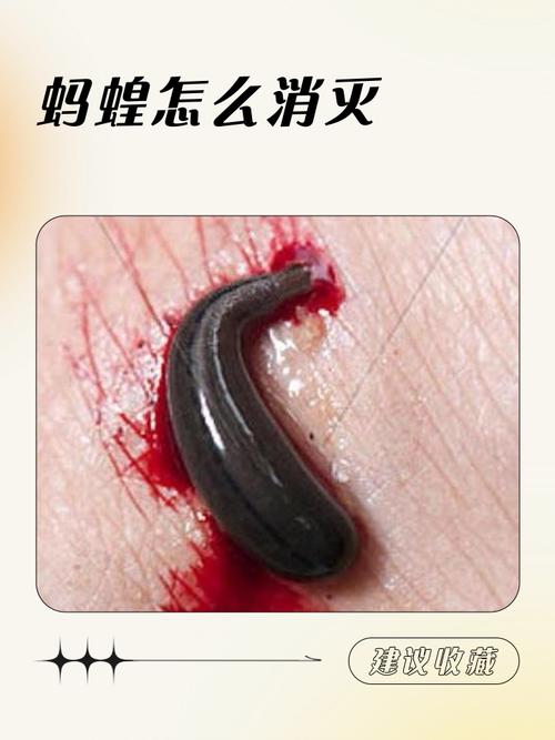 水蛭vs寄生虫缩略图