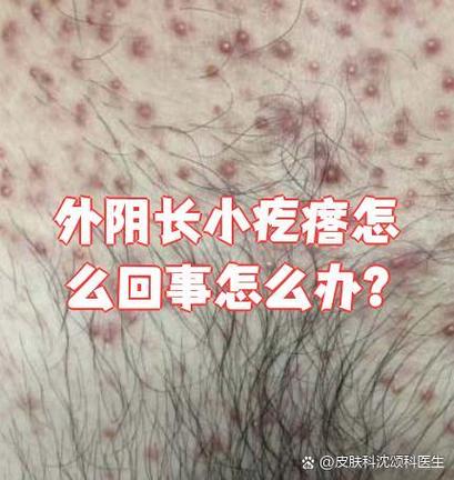 女生下面长了小疙瘩怎么回事图标