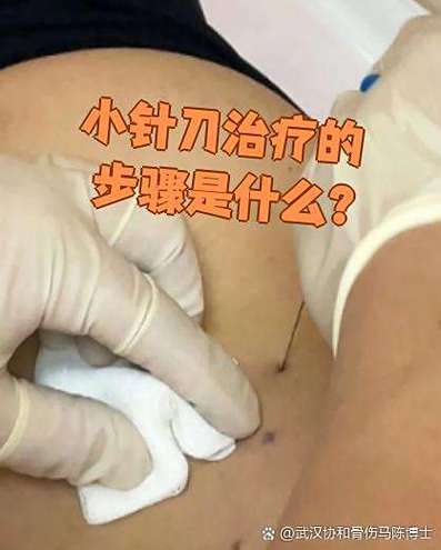 如何把刺从肉里取出