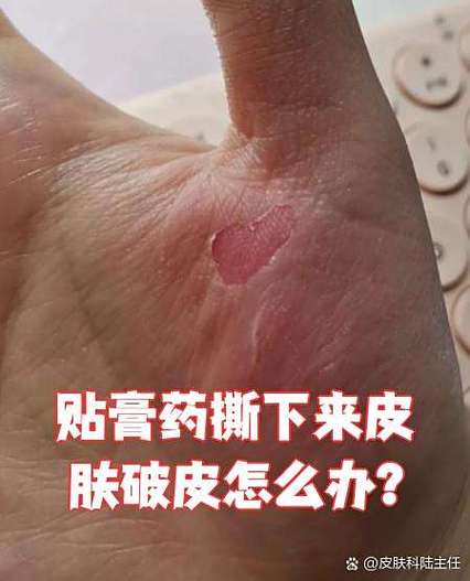 膏药贴撕掉后留下胶怎么去掉截图