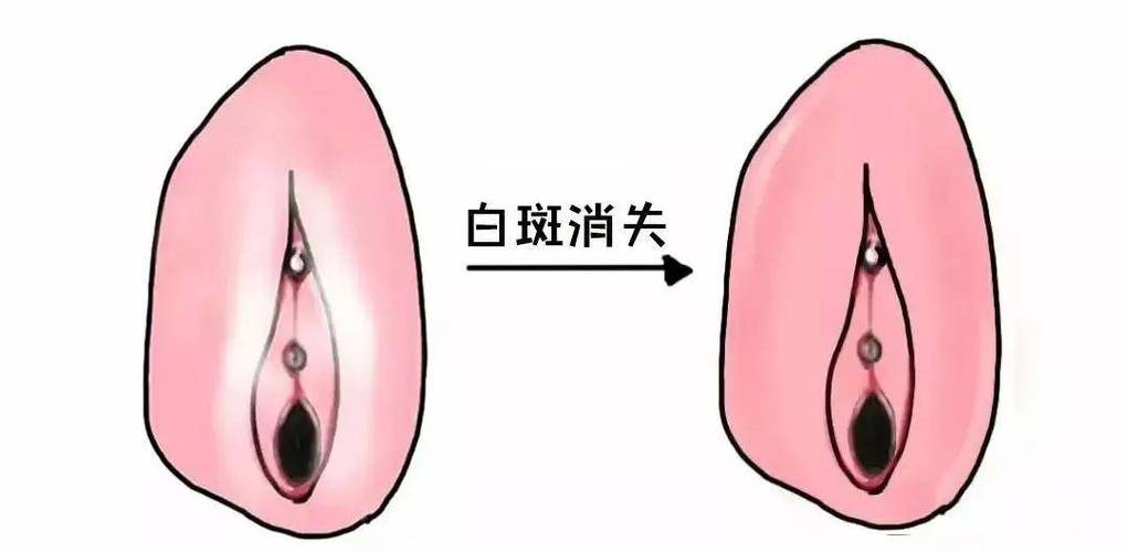 外阴白斑能不能同房截图