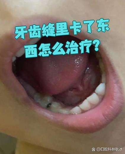 牙洞里卡了硬物小妙招