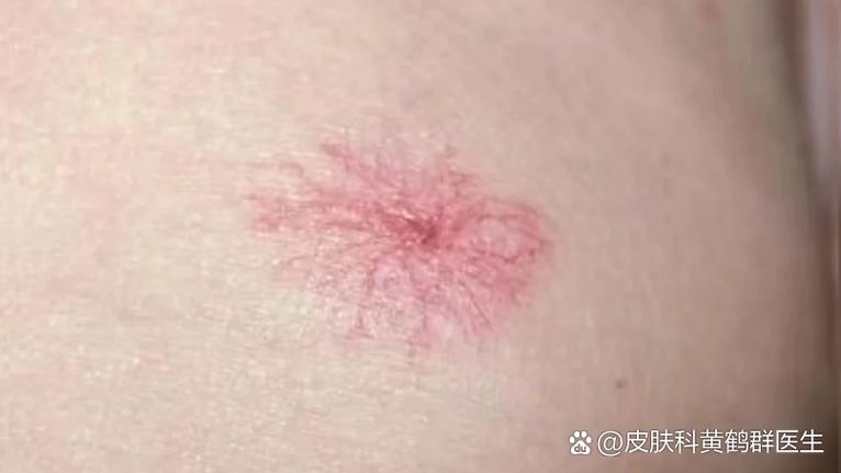 蜘蛛痣的治疗方法图标