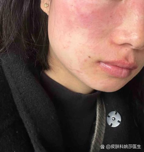 面部季节性过敏怎么治图标