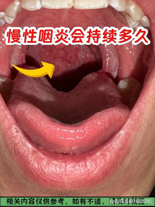 咽喉痛绿色痰要警惕了