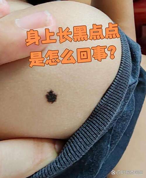 身上起黑点是怎么回事截图
