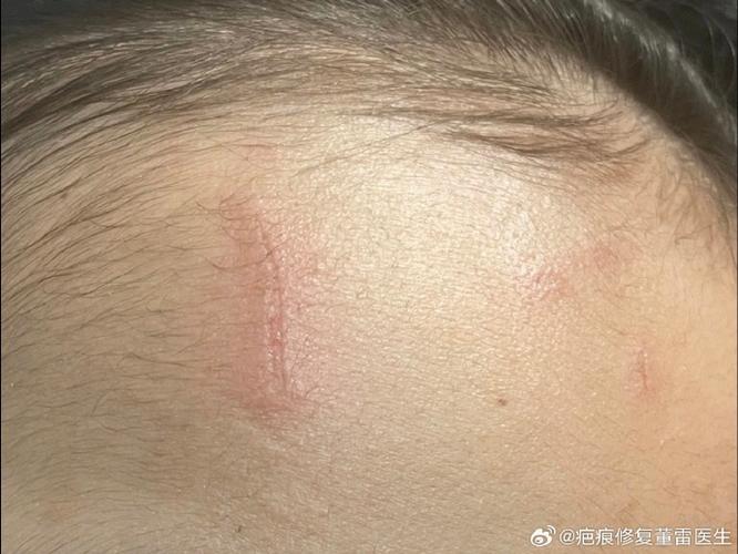 身上莫名有刮痕结痂图标