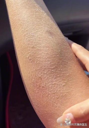 女生说鸡皮疙瘩掉一地怎么回复截图