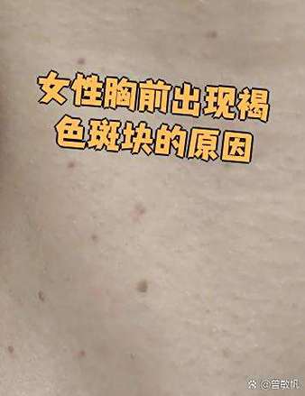 身上突然出现浅褐色的斑图标