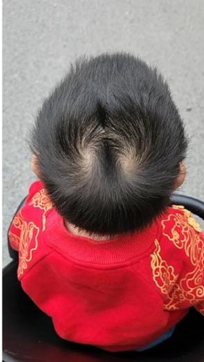 发旋容易掉发有什么玄学说法截图