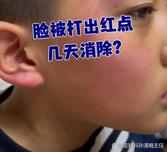 脸部淤血一般多久消除图标