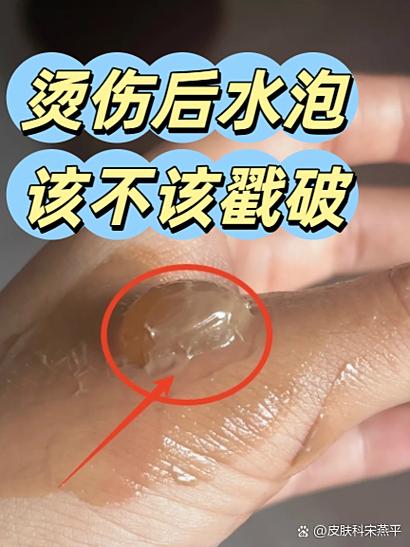 水泡不戳破它自己会消吗截图