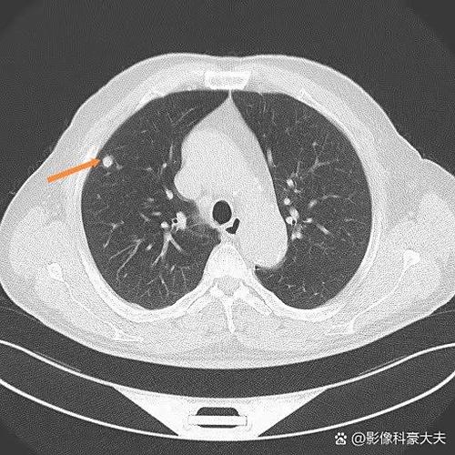 肺结节im的含义图标