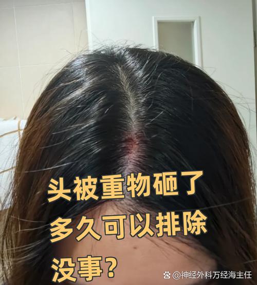 重物砸到头顶会怎么样截图