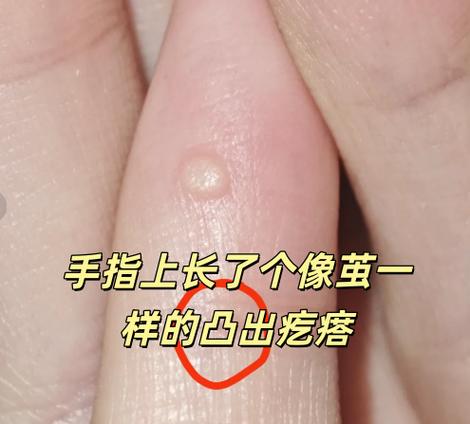手指上像茧一样的硬皮
