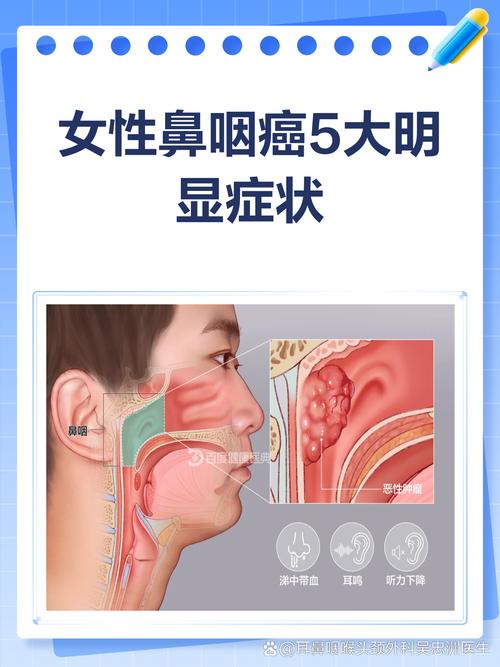 女性鼻咽癌图片