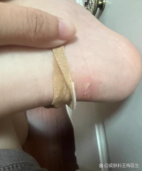 鞋后跟磨脚的小妙招截图