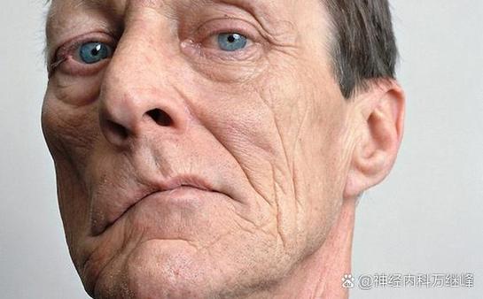 面部肌肉僵硬截图