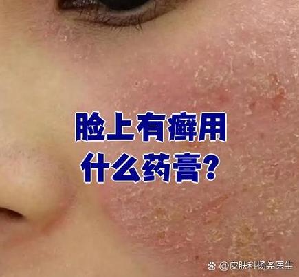 脸癣图片和症状图片图标