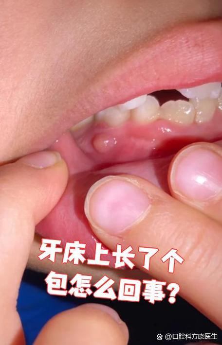 牙龈上鼓出了个包怎么处理截图