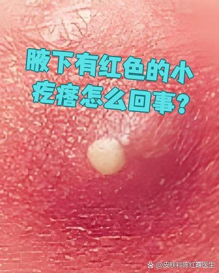 腋窝红色疙瘩图片图标