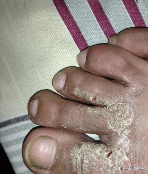 脚特别痒而且越挠越痒用什么药膏