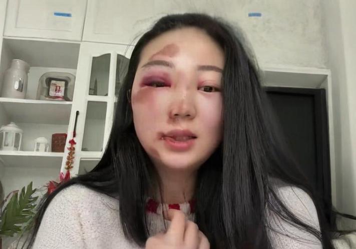 被打的照片 鼻青脸肿图标