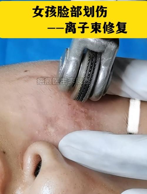 离子束祛疤多少钱一次图标