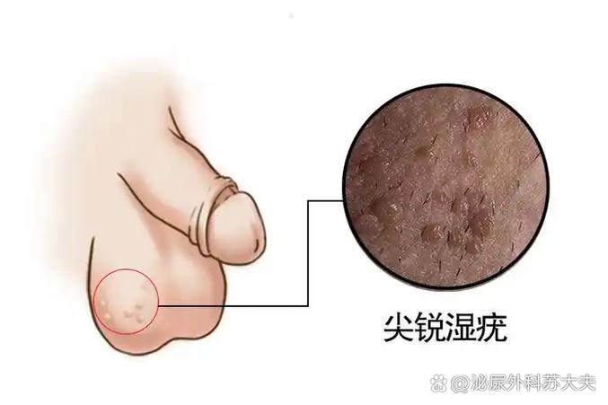 优疣最好的治疗方法截图