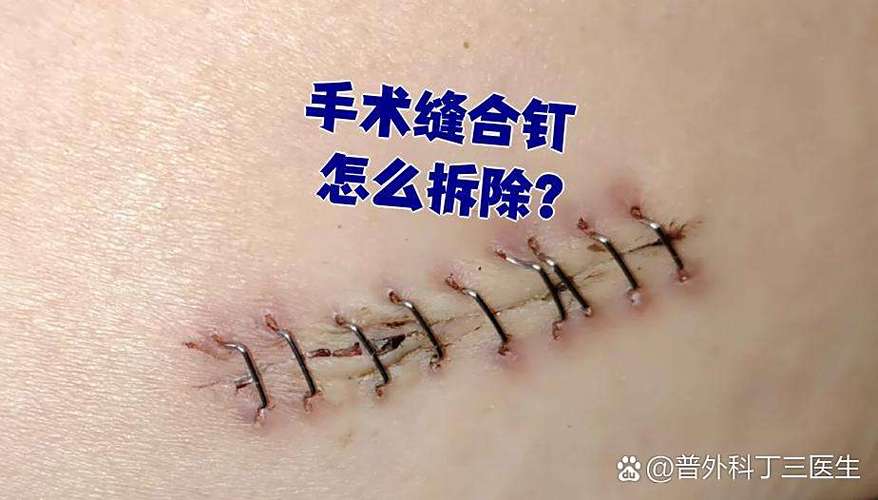 钉进去的钉子怎么取下来图标