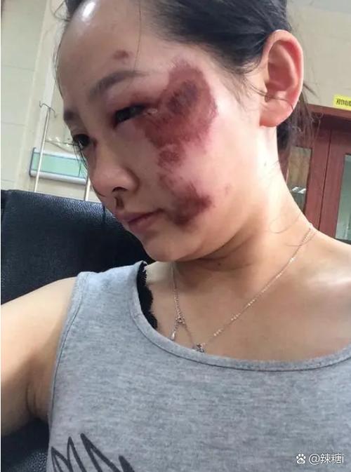 女生脸部受伤的真实照片图标
