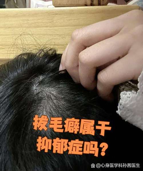 拔毛癖是什么心理疾病图标