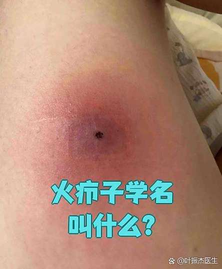严重的疖肿图片图标