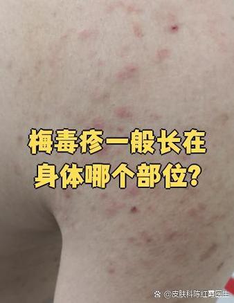 早期梅毒疹子图片图标