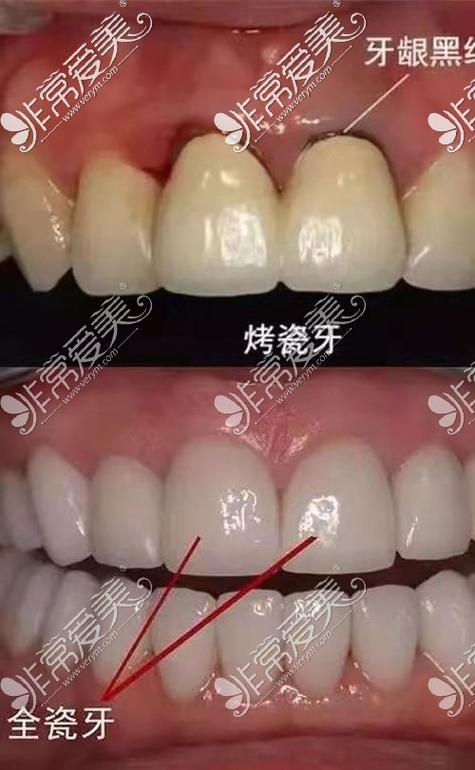 全瓷牙和烤瓷牙哪个好截图