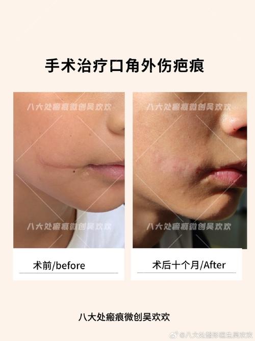 plasma治疗疤痕图标