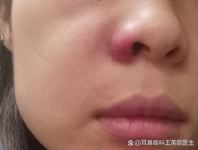 鼻子一侧疼按压有疼痛感截图