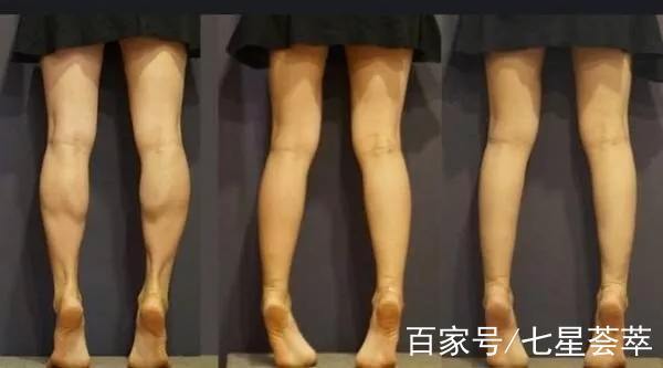 跑步腿会变粗吗
