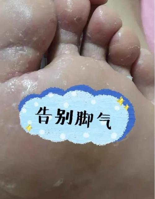 碘伏能杀死脚气真菌吗图标