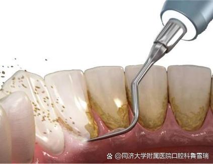 如何让松动的牙齿快速脱落截图